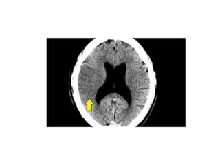 Cerebrovascular Diseases 2 Pptx