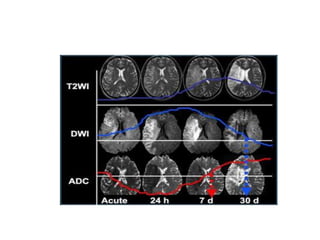 Cerebrovascular Diseases 2 Pptx
