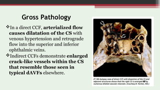 Imaging in Cerebrovascular Malformations | PPT