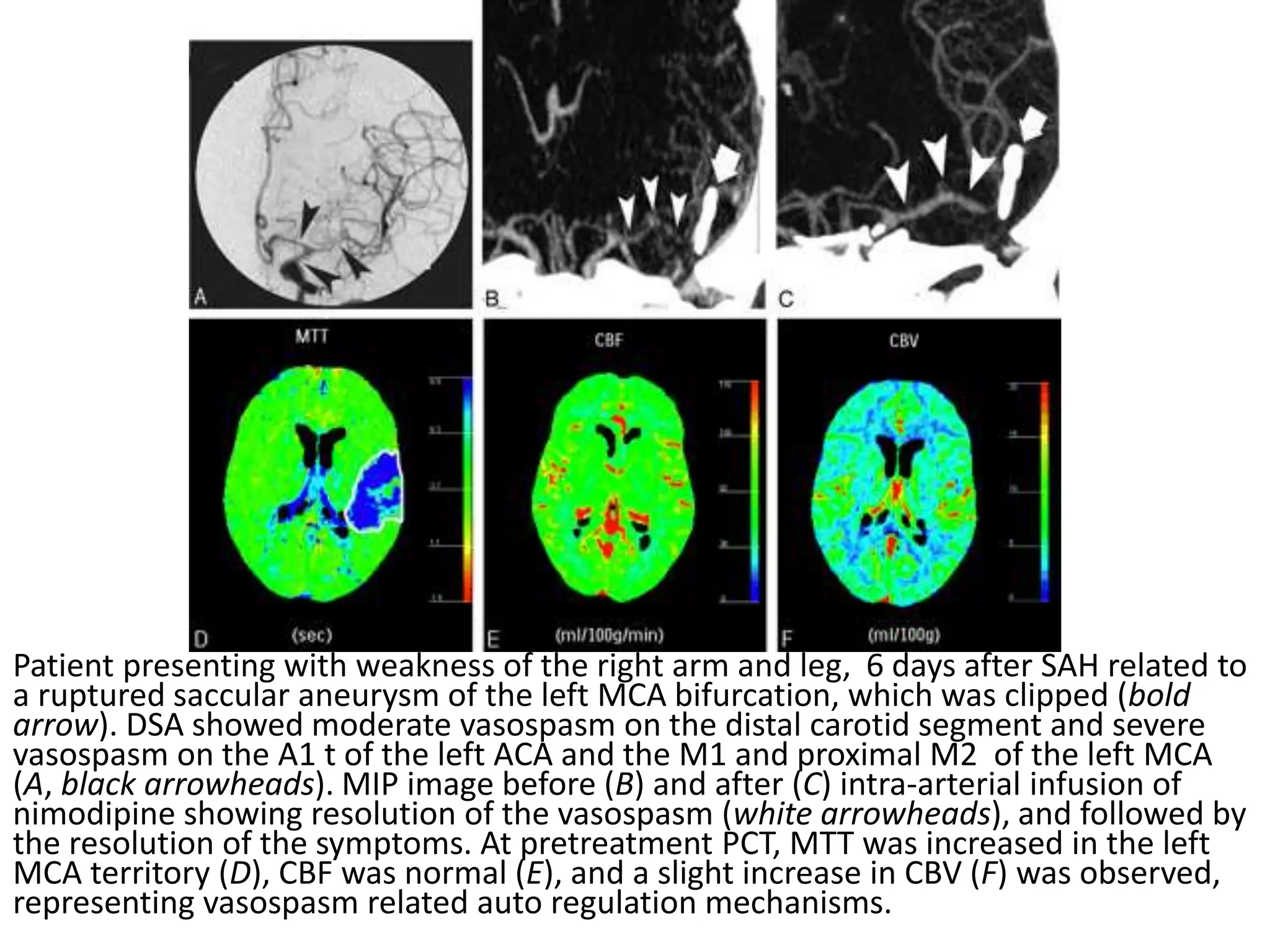 Cerebrovascular Vasospasm - Etiopathogenesis and Management | PPTX