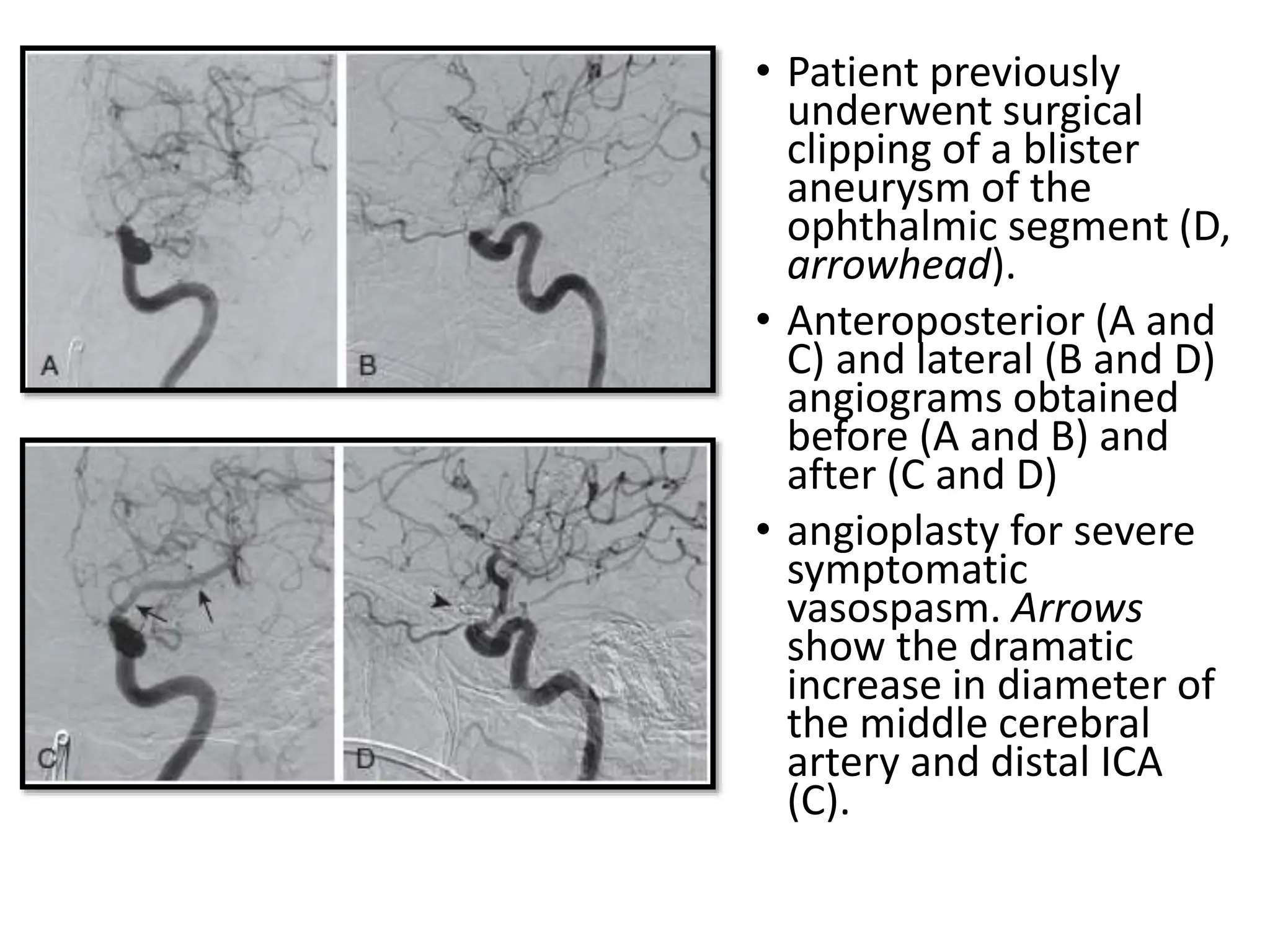 Cerebrovascular Vasospasm - Etiopathogenesis and Management | PPTX