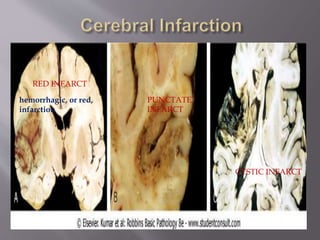 Cerebrovasculr accident | PPTX | Blood Disorders | Diseases and Conditions