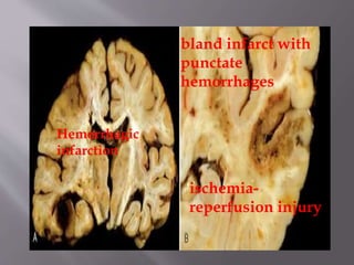 Cerebrovasculr accident | PPTX | Blood Disorders | Diseases and Conditions
