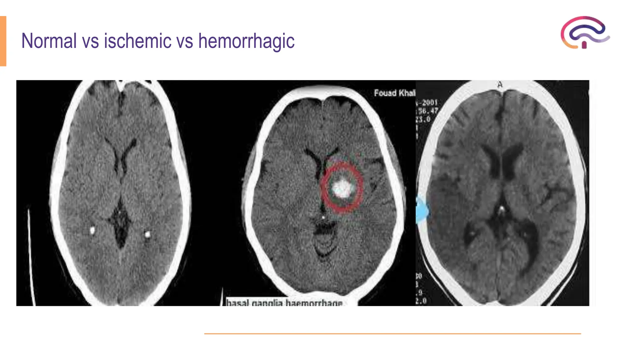 cerebrovasular disease(ischemic, ICH & SAH).pptx