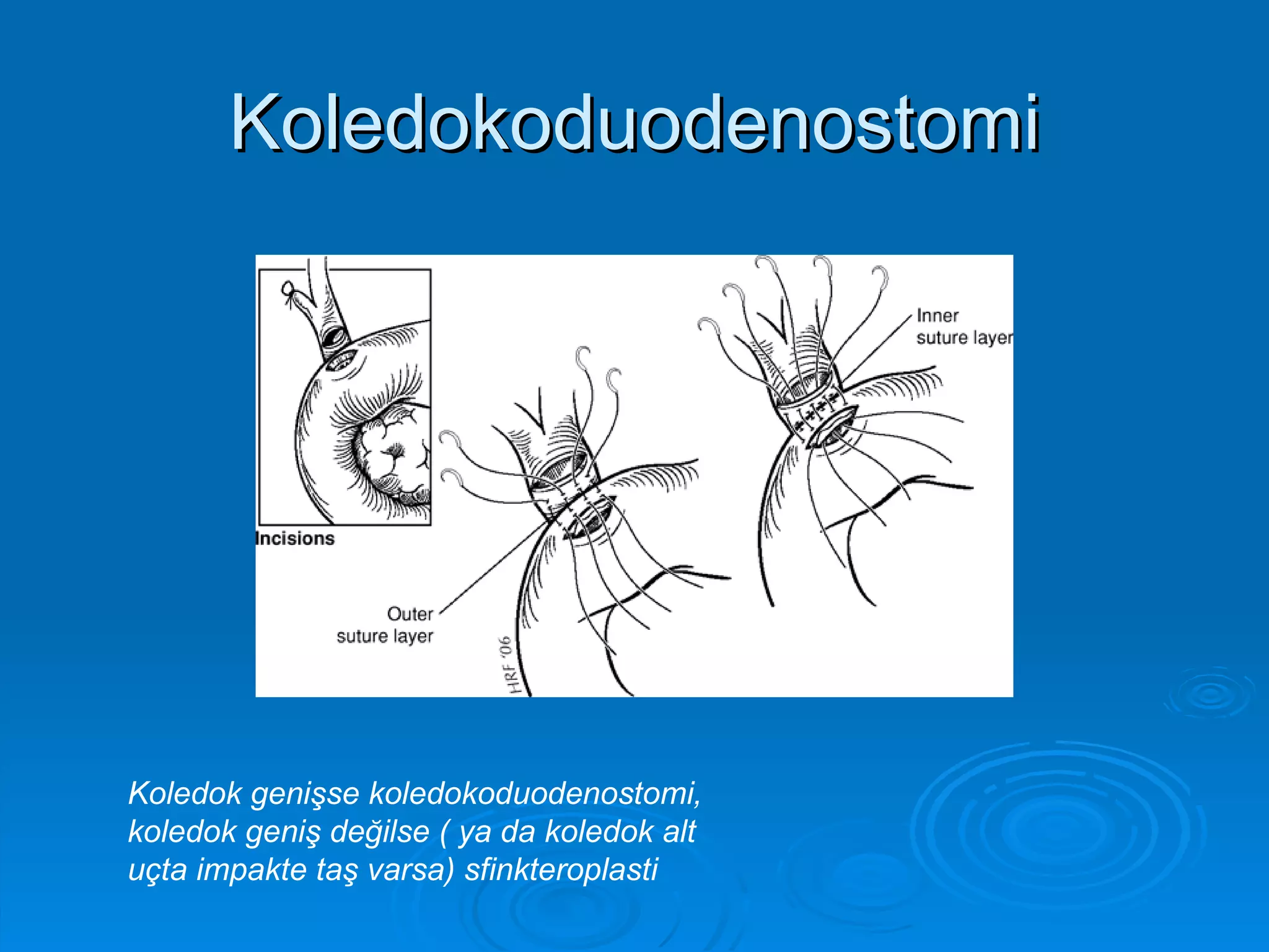 Cerrahi sariliklar | PPT