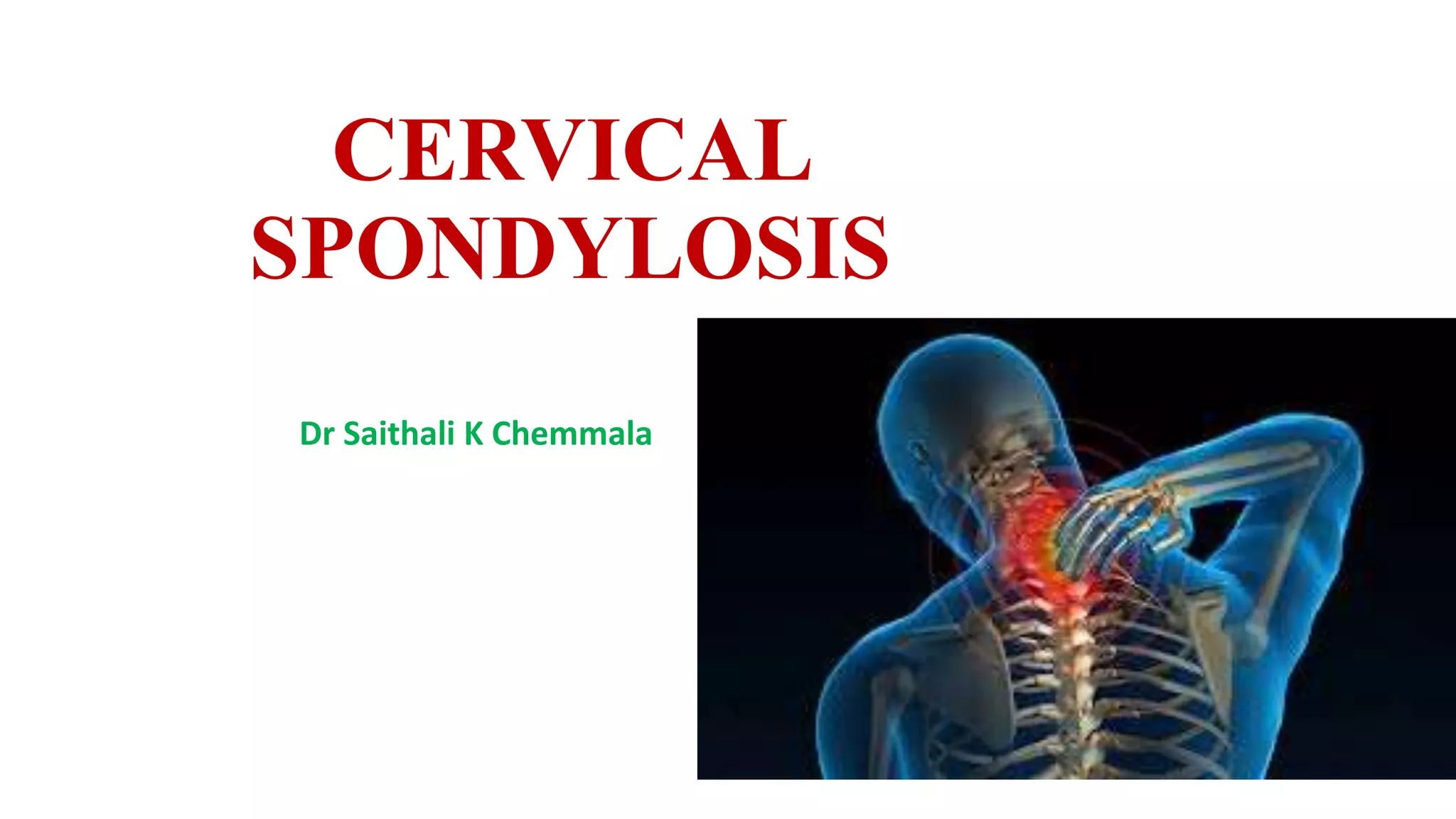 Cervical Spondylosis | PPT