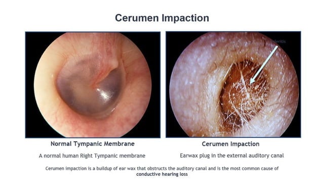 conditions of the external ear cerumen impaction | PPTX | Ear, Nose and Throat Conditions ...