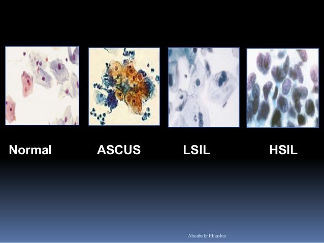 Screening for cervical cancer