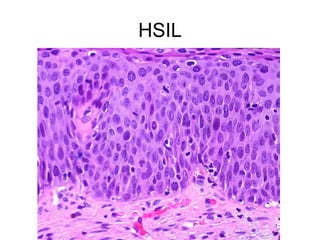 Invasive cervical cancer in pregnancy.pdf