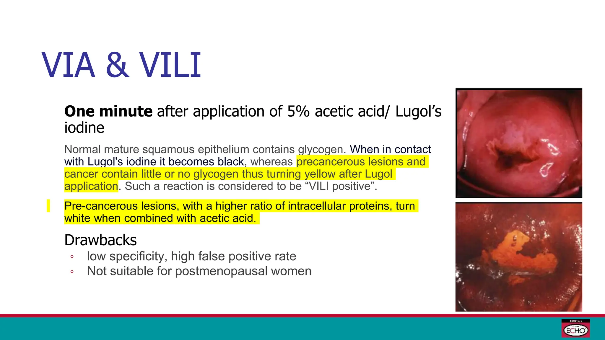 CERVICAL-CANCER-introduction, screening and prevention | PPTX