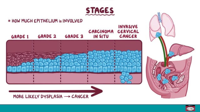 CERVICAL-CANCER-introduction, screening and prevention | PPTX
