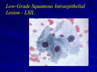 Cervical Cancer Screening - HPV - www.jinekolojivegebelik.com