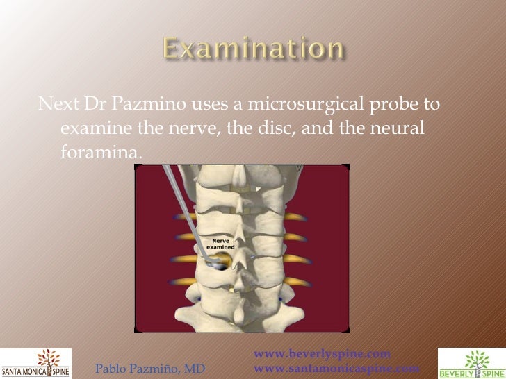 Cervical Posterior Foraminotomy by Pablo Pazmino MD