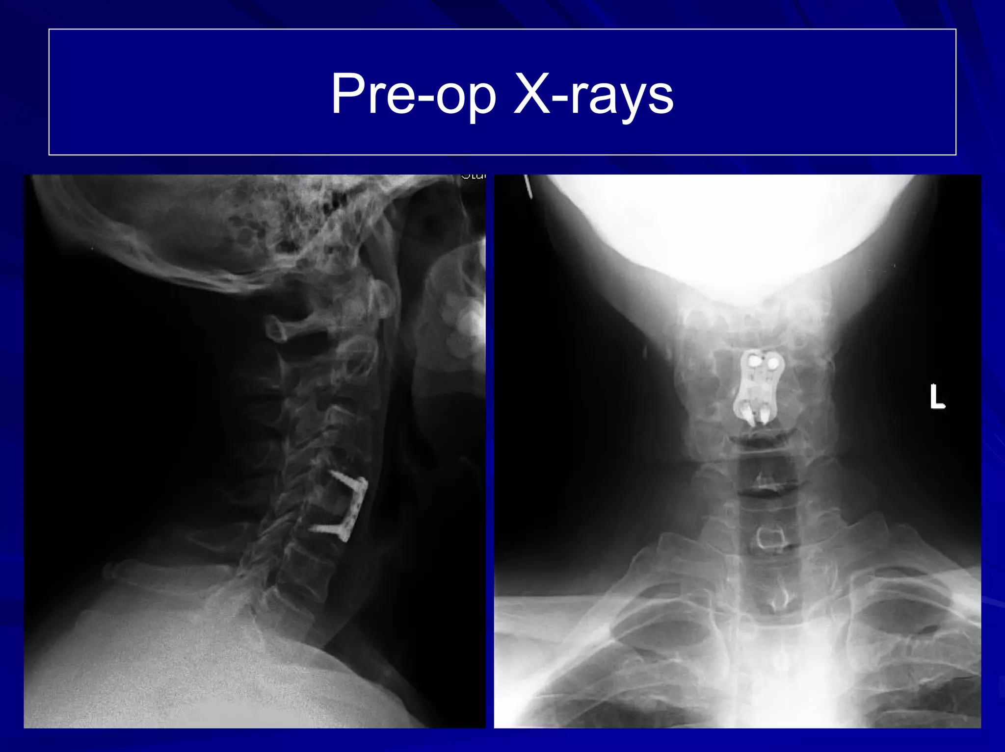 Case Review #5: 62 year old male with degenerative disc disease C2-C6 | PDF