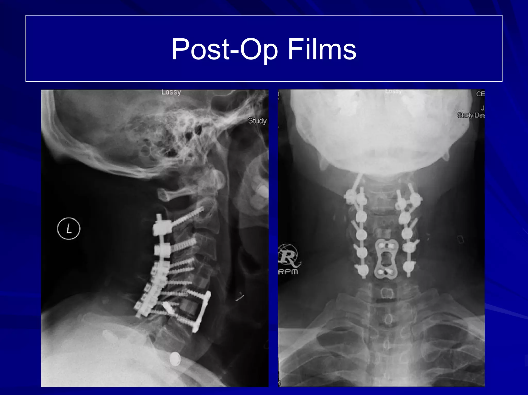 Case Review #5: 62 year old male with degenerative disc disease C2-C6 | PDF