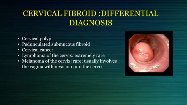 Cervical and broad ligament fibroid | PPTX