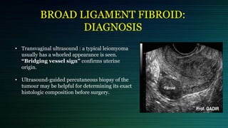 Cervical and broad ligament fibroid | PPT
