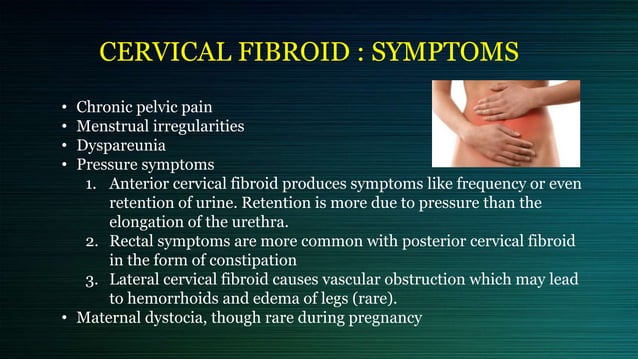 Cervical and broad ligament fibroid | PPT