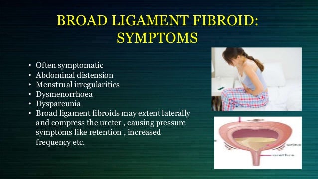 Broad Ligament Cervical Fibroid