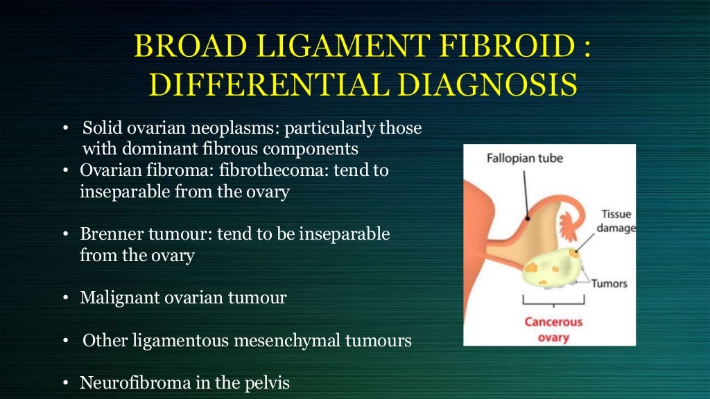 Cervical and broad ligament fibroid