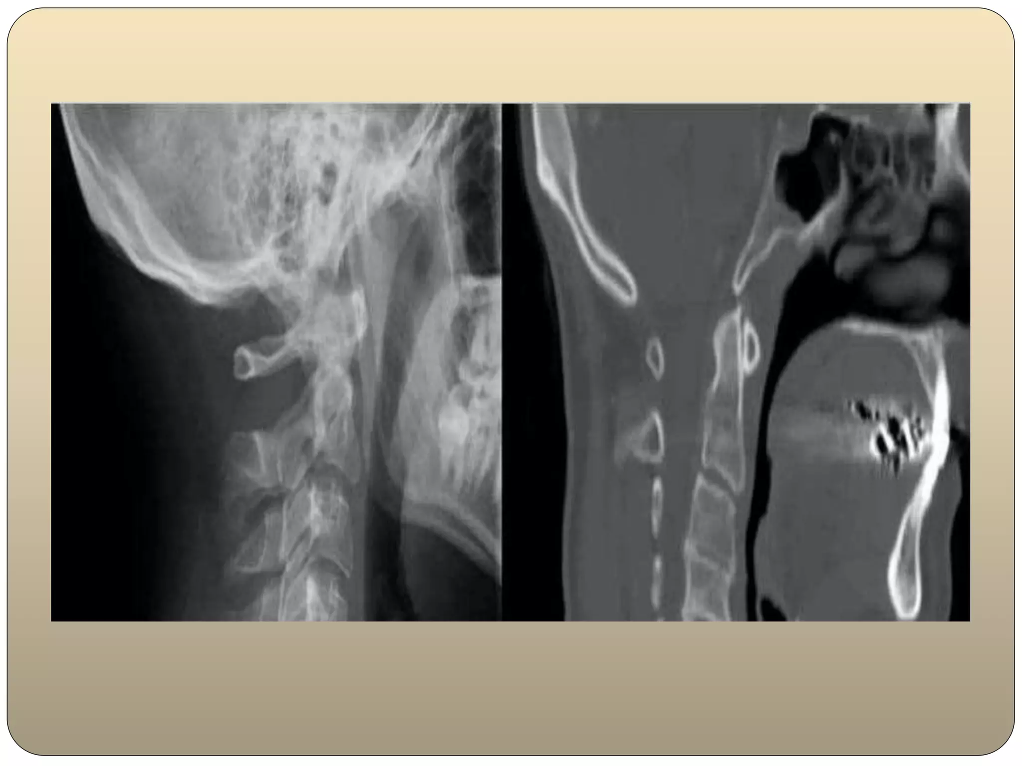 Congenital anomalies and Normal skeletal variants- Cervical spine | PPT