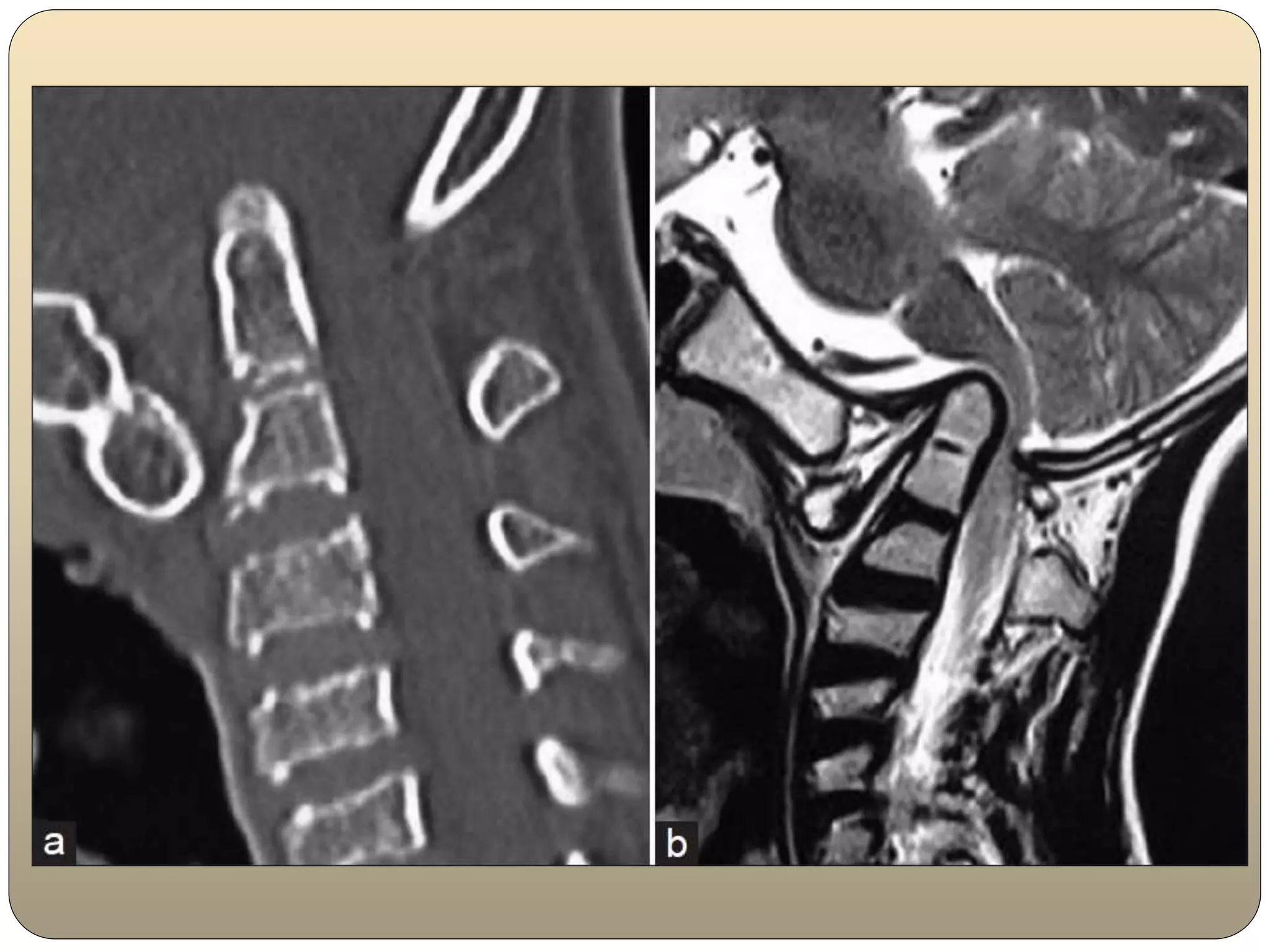 Congenital anomalies and Normal skeletal variants- Cervical spine | PPT
