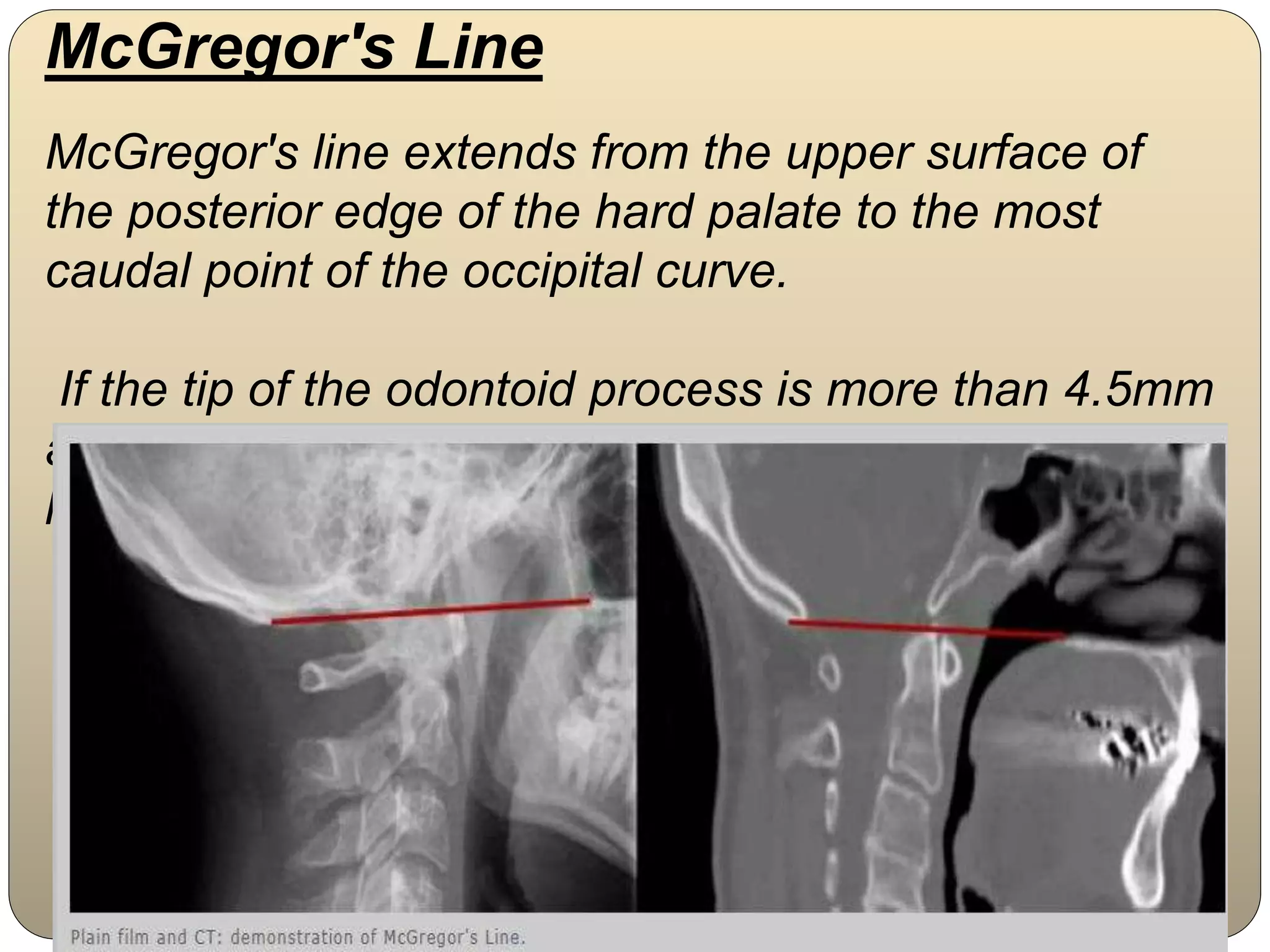 Congenital anomalies and Normal skeletal variants- Cervical spine | PPT