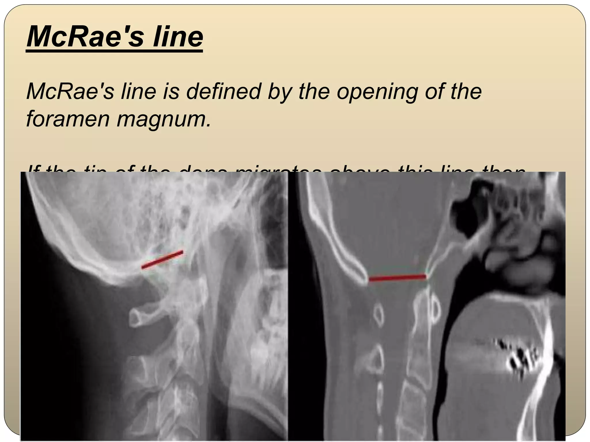 Congenital anomalies and Normal skeletal variants- Cervical spine | PPT