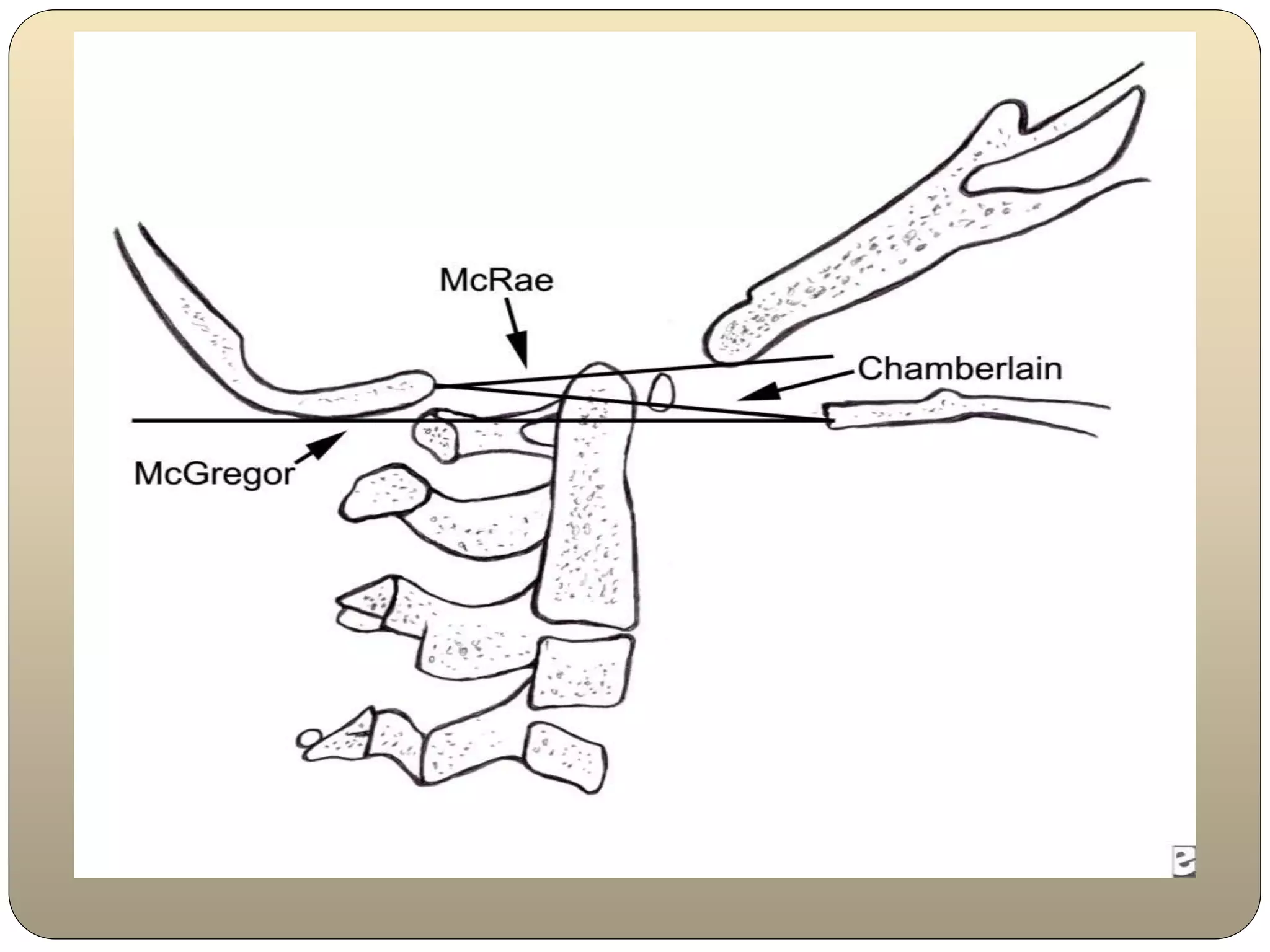 Congenital anomalies and Normal skeletal variants- Cervical spine | PPT