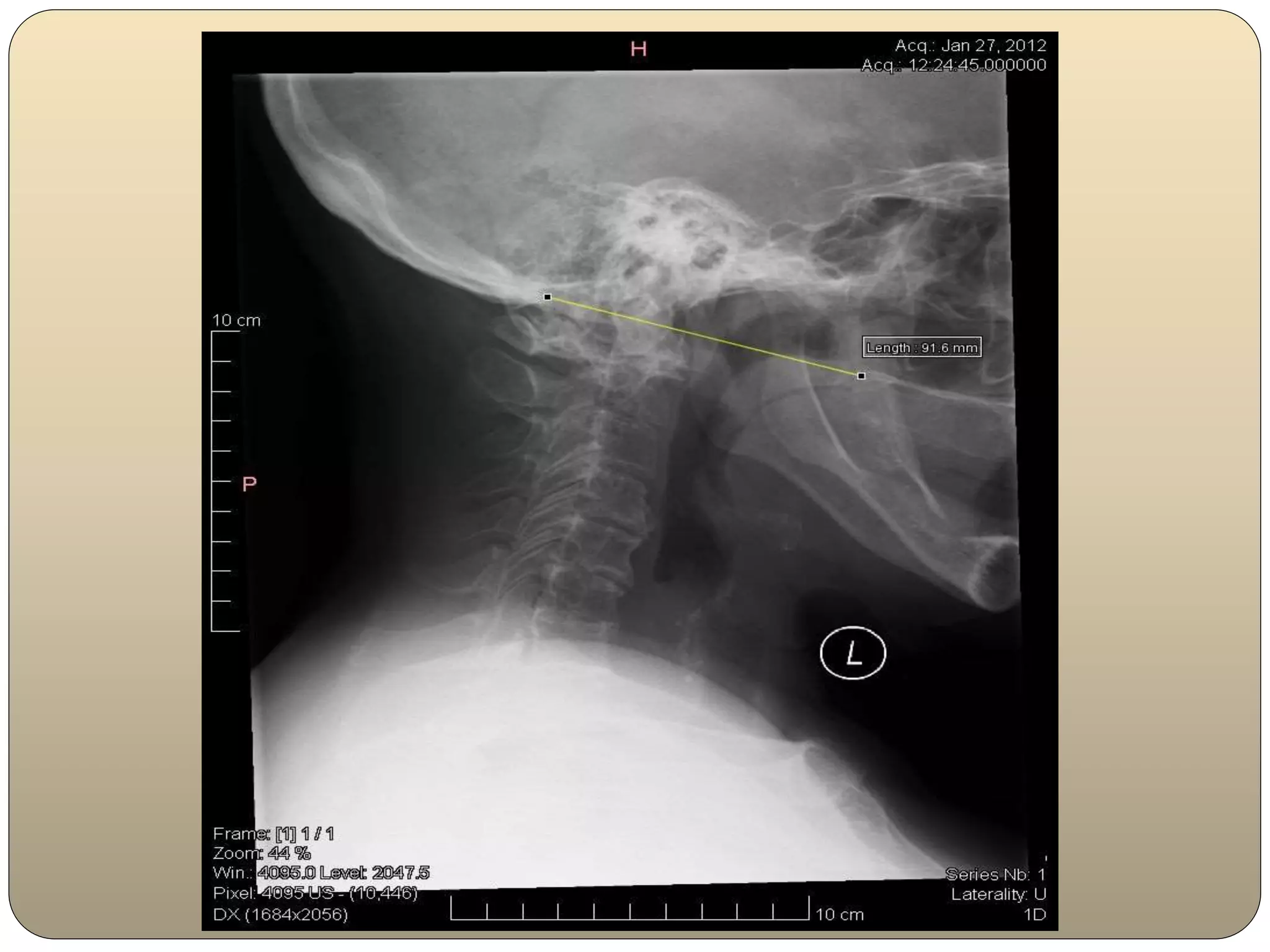 Congenital anomalies and Normal skeletal variants- Cervical spine | PPT