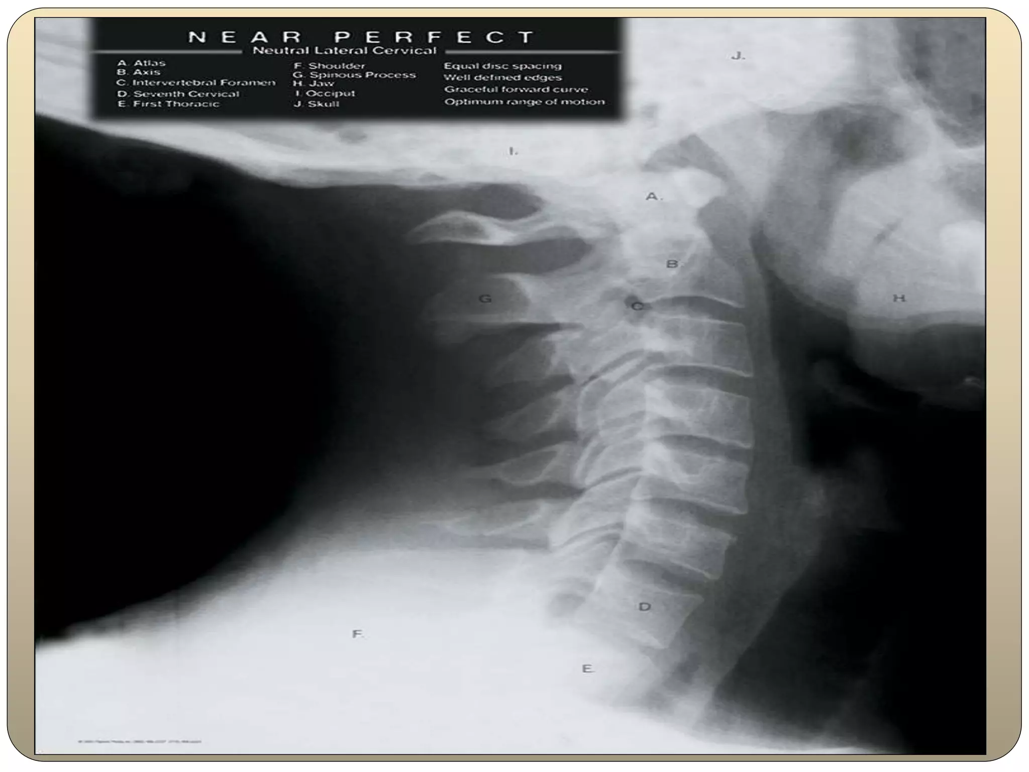 Congenital anomalies and Normal skeletal variants- Cervical spine | PPT