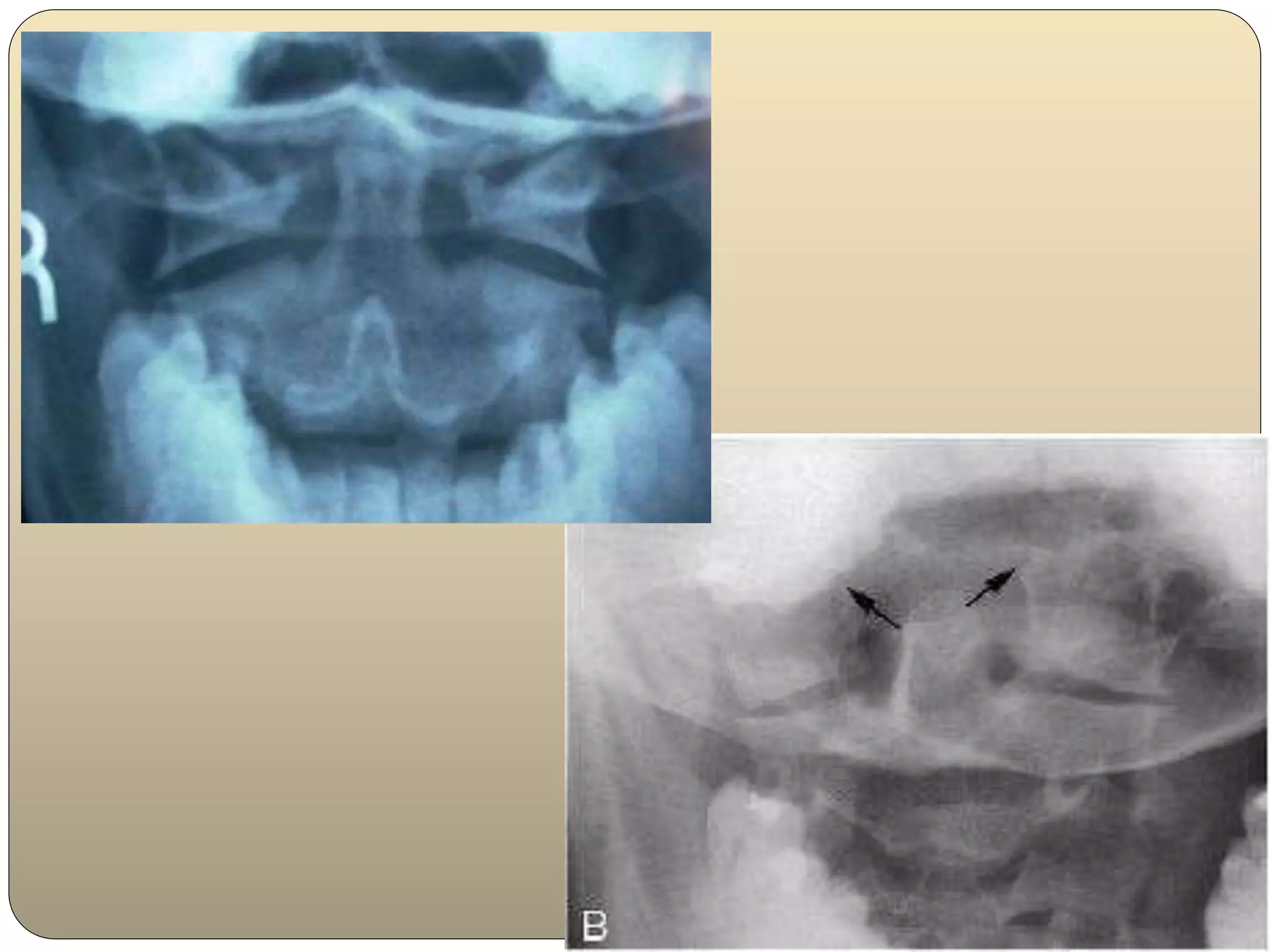Congenital anomalies and Normal skeletal variants- Cervical spine | PPT