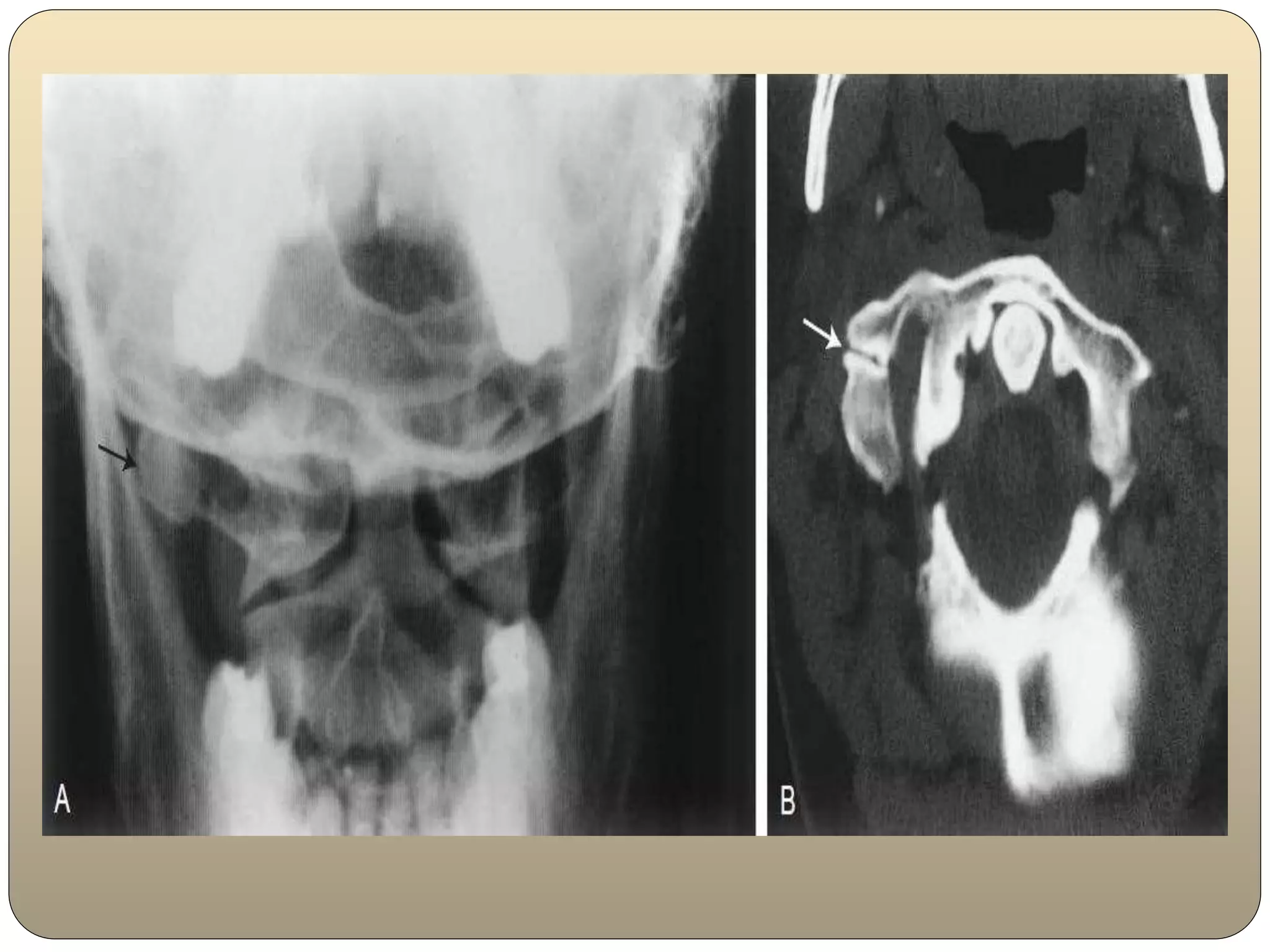 Congenital anomalies and Normal skeletal variants- Cervical spine | PPT