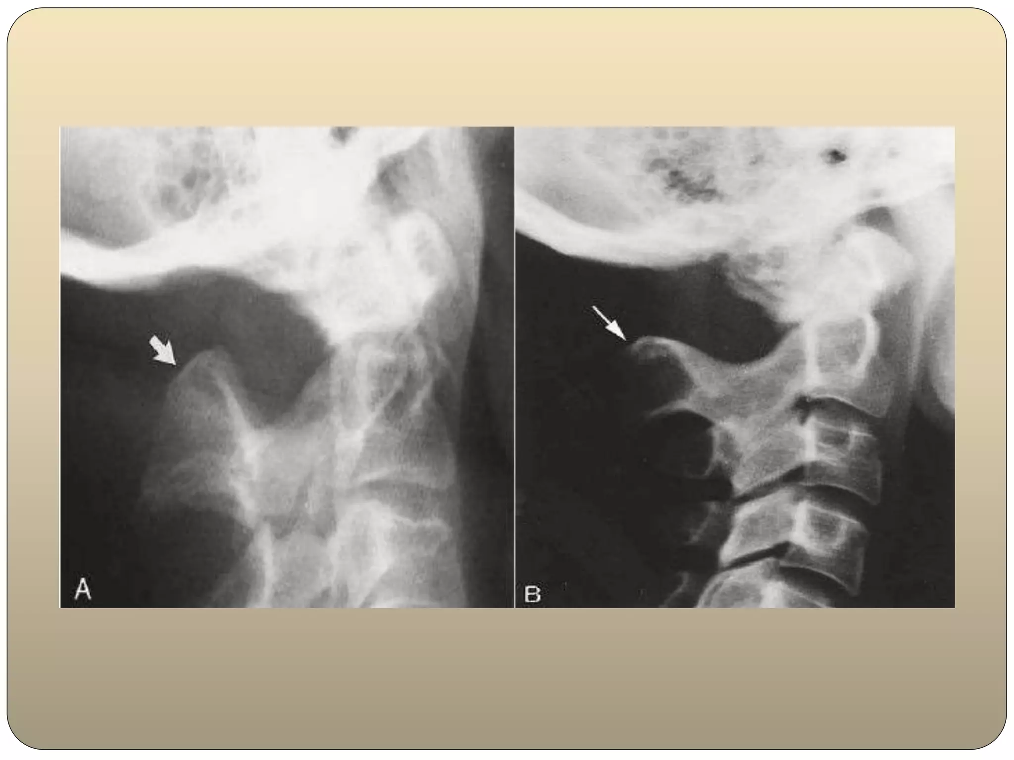 Congenital anomalies and Normal skeletal variants- Cervical spine | PPT