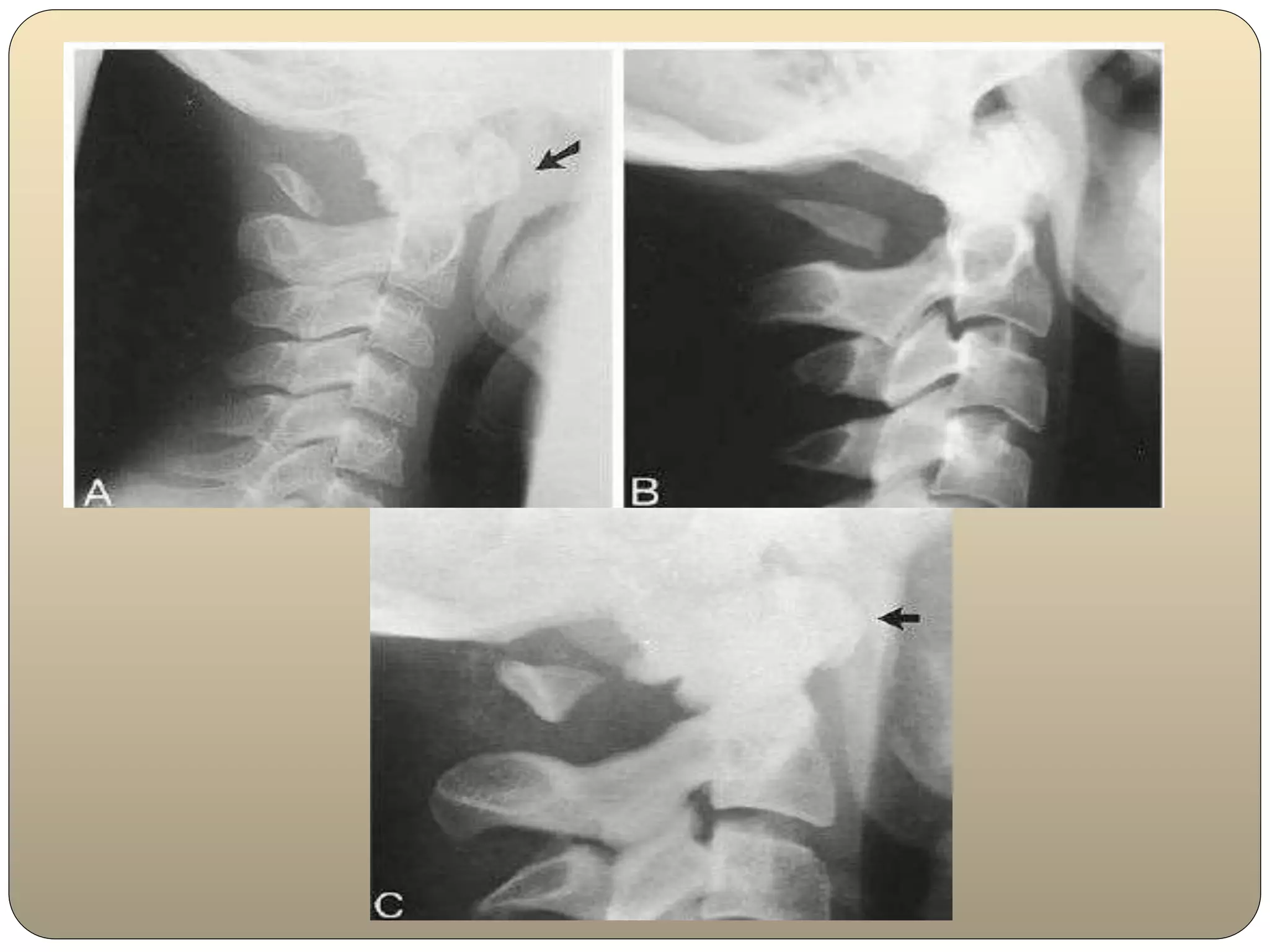 Congenital anomalies and Normal skeletal variants- Cervical spine | PPT