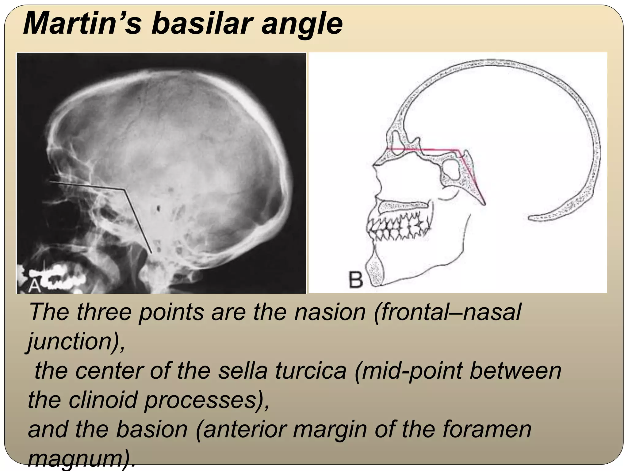 Congenital anomalies and Normal skeletal variants- Cervical spine | PPT