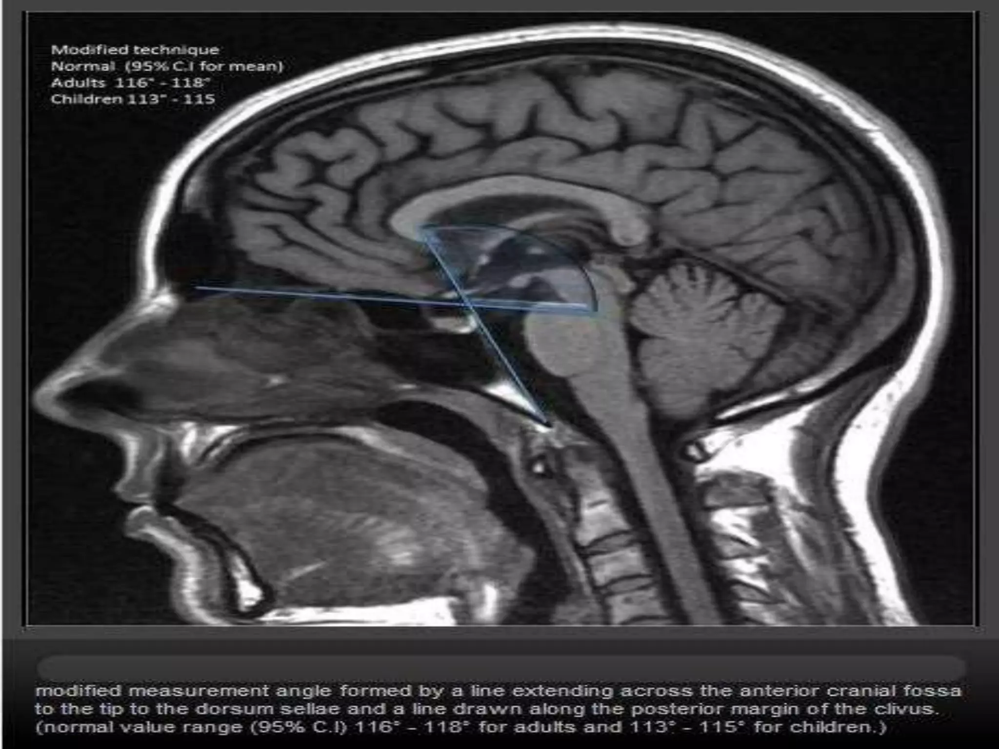 Congenital anomalies and Normal skeletal variants- Cervical spine | PPT