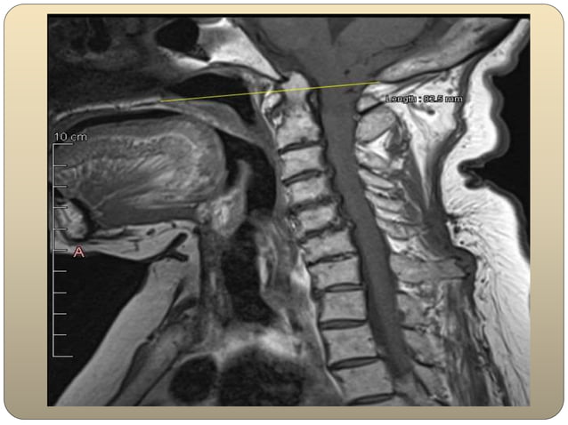 Congenital anomalies and Normal skeletal variants- Cervical spine | PPT