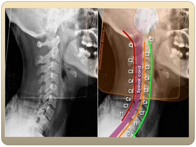 Congenital anomalies and Normal skeletal variants- Cervical spine | PPT