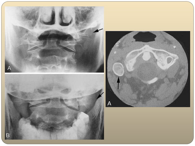 Congenital anomalies and Normal skeletal variants- Cervical spine | PPT