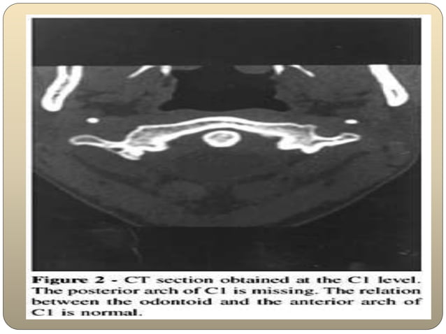 Congenital anomalies and Normal skeletal variants- Cervical spine | PPT