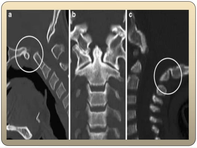 Congenital anomalies and Normal skeletal variants- Cervical spine