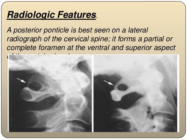 Congenital anomalies and Normal skeletal variants- Cervical spine