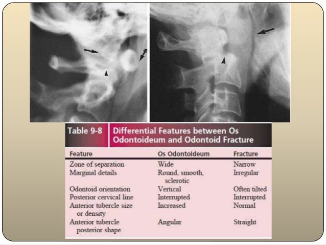 Droopy Shoulder Syndrome