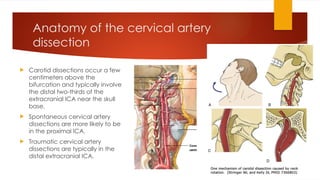 Cervical arterial dissection GCH 04-20-2023.pptx