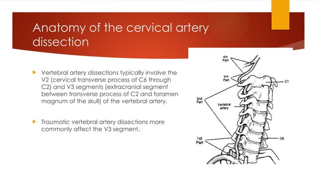 Cervical arterial dissection GCH 04-20-2023.pptx