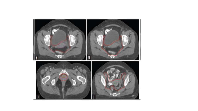 cervical cancer conformal radiotherapy planning (3D CRT) | PPTX