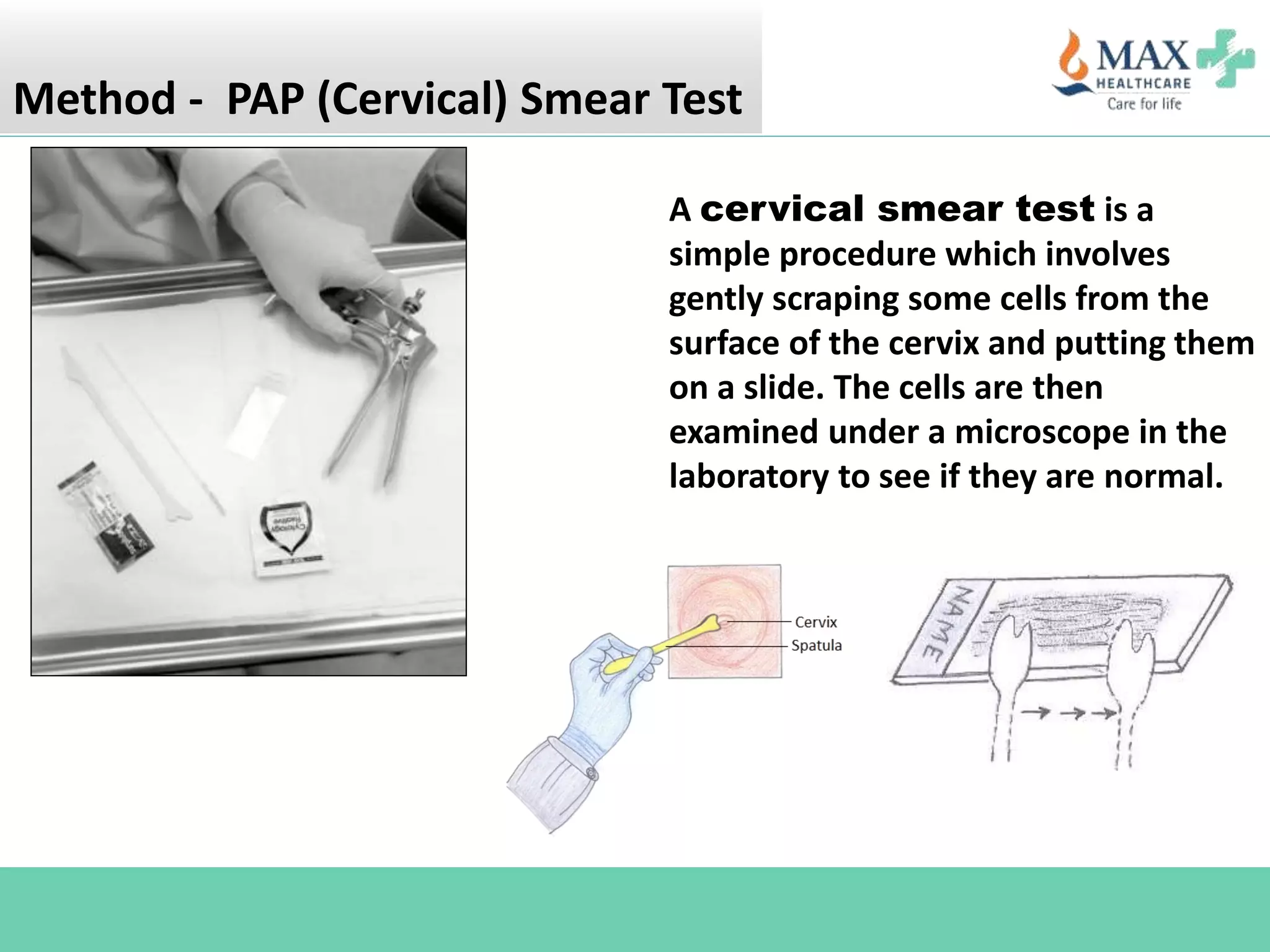 Cervical cancer - Role of screening and management of advanced stage ...
