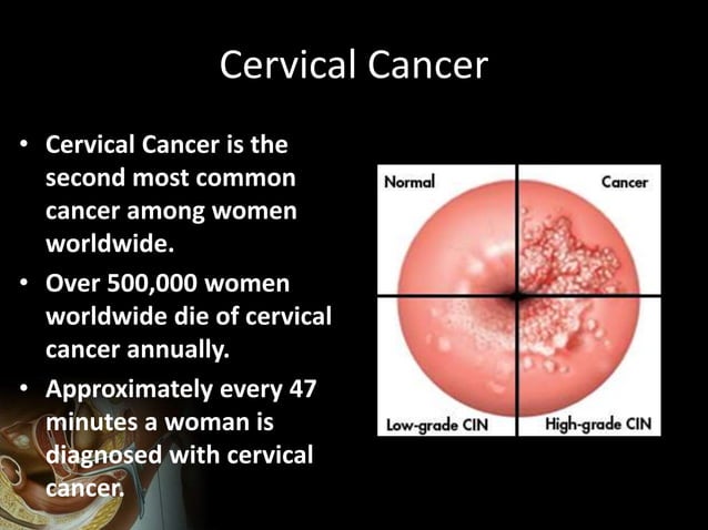 Cervical cancer | PPTX | Reproductive Health | Diseases and Conditions