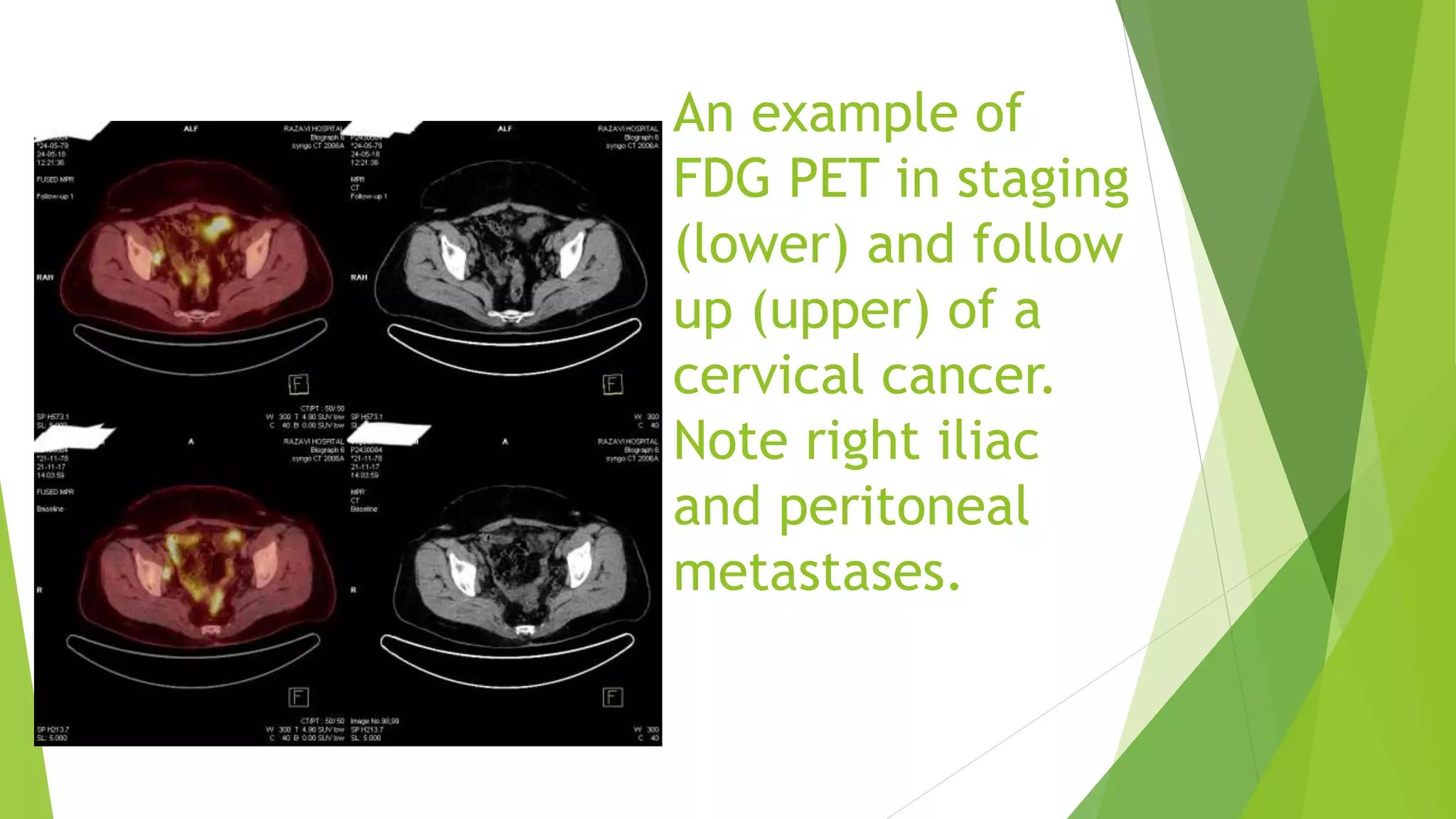Nuclear Medicine application in uterine cervix cancer | PPTX